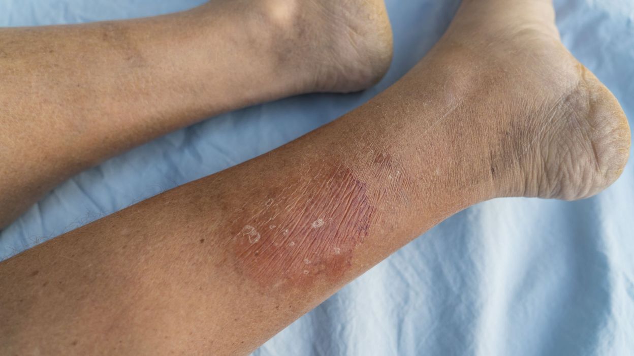 Comment reconnaître l'érysipèle et comment traiter cette infection de ...