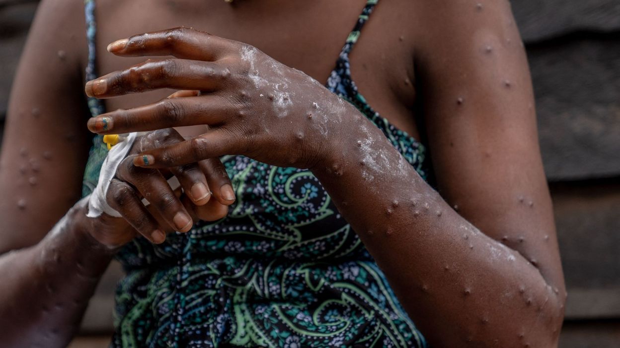 Épidémie de Mpox : l’OMS déclenche son plus haut niveau d’alerte ...