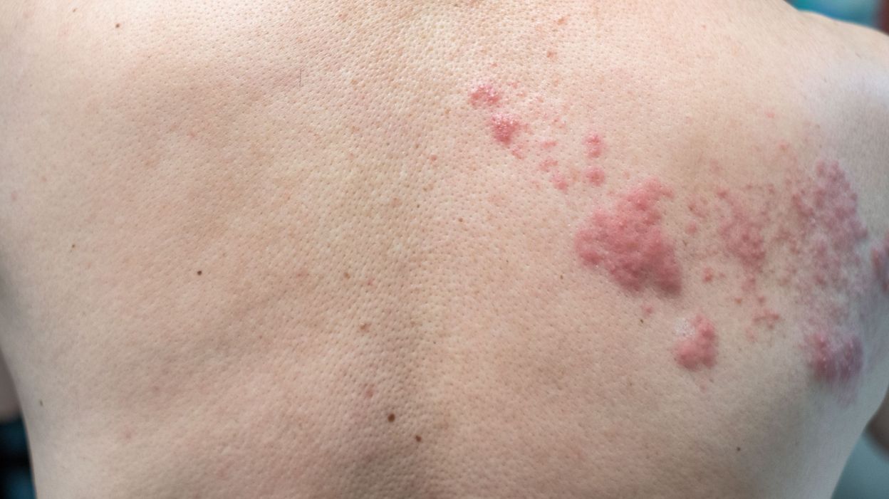 Vaccin contre le zona : efficace, mais trop cher pour le Centre fédéral ...
