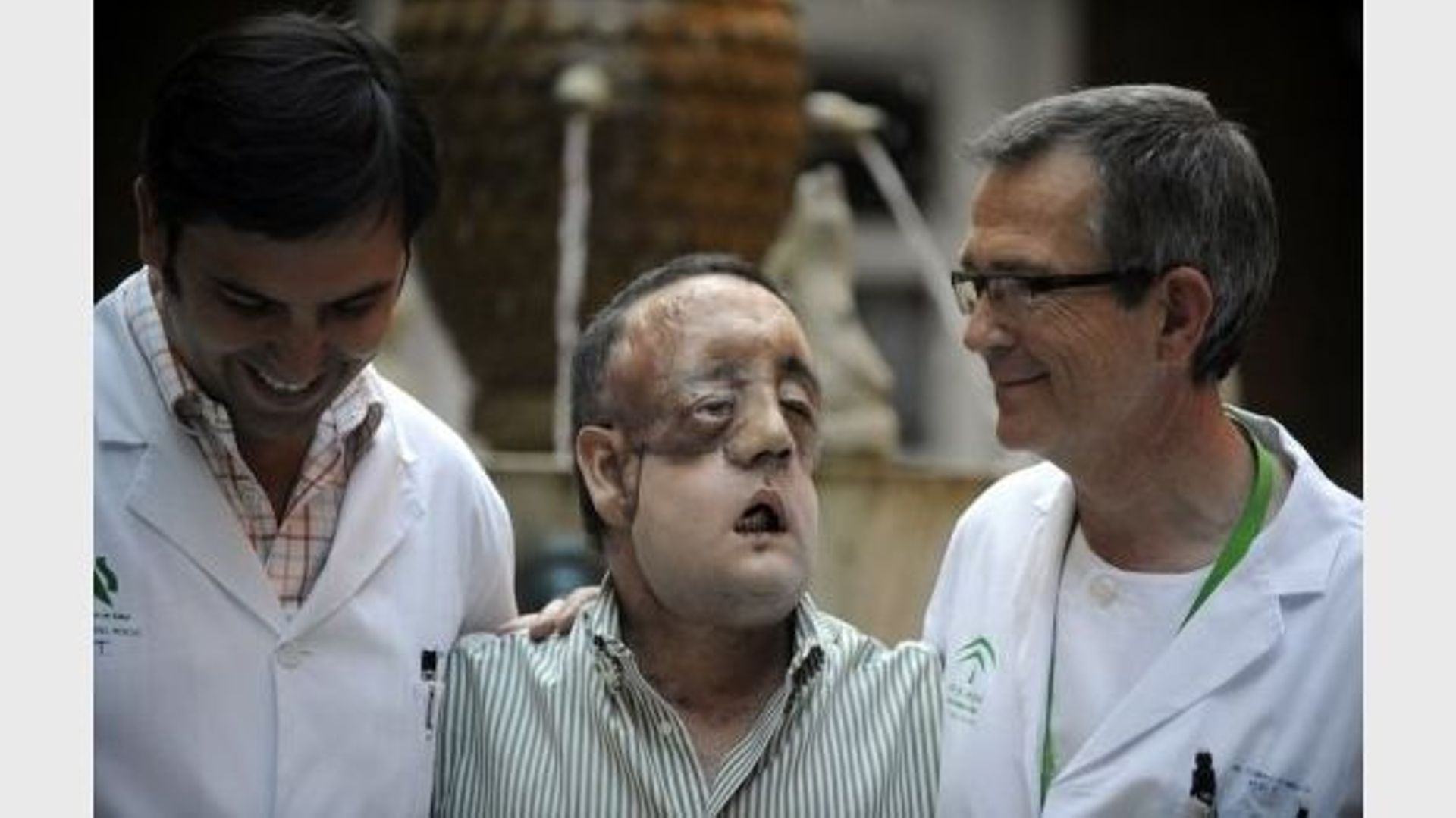 Une greffe totale du visage réussie en France - RTBF Actus