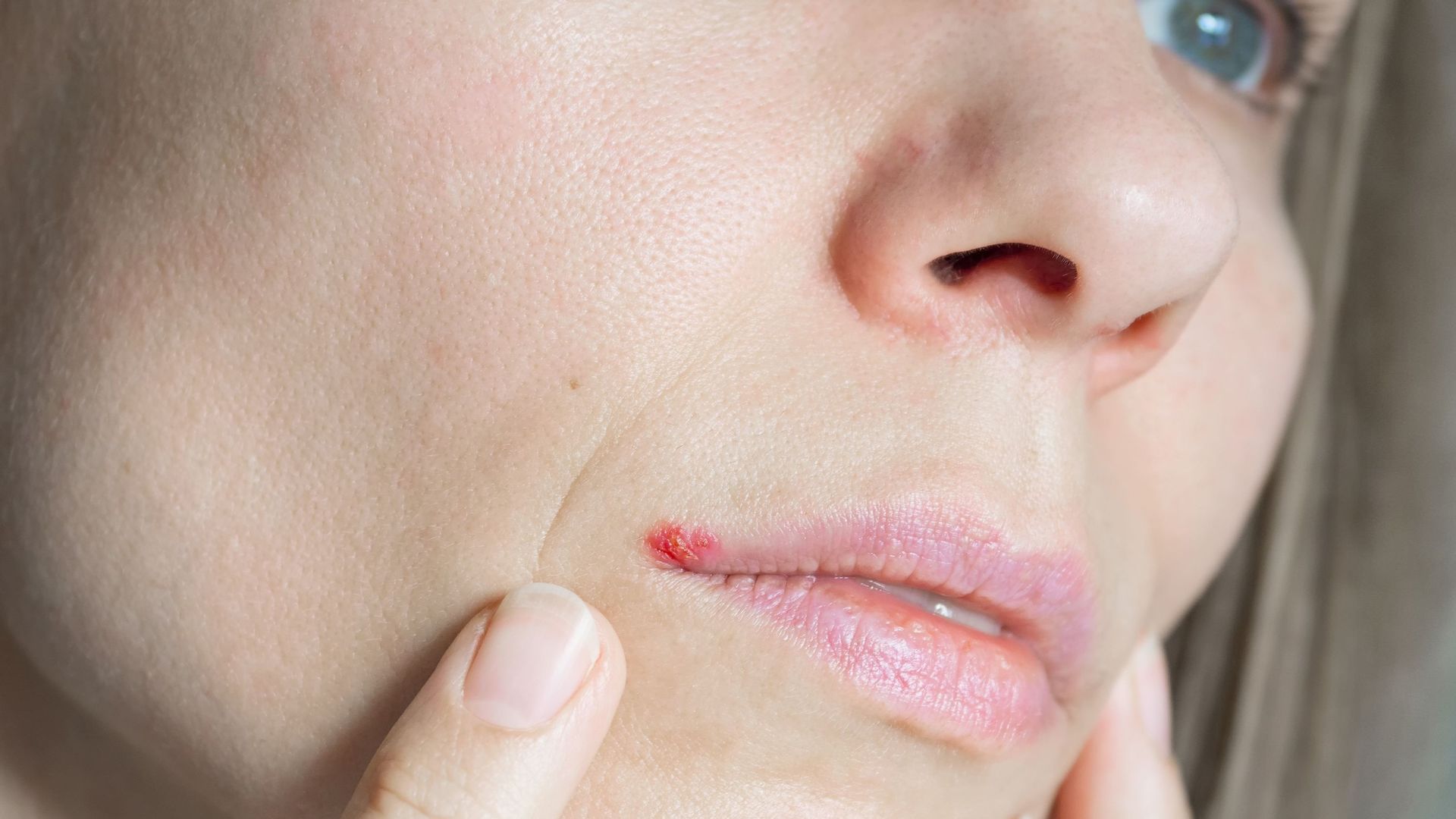 La perlèche ou chéilite angulaire : quésaco docteur ? - RTBF Actus
