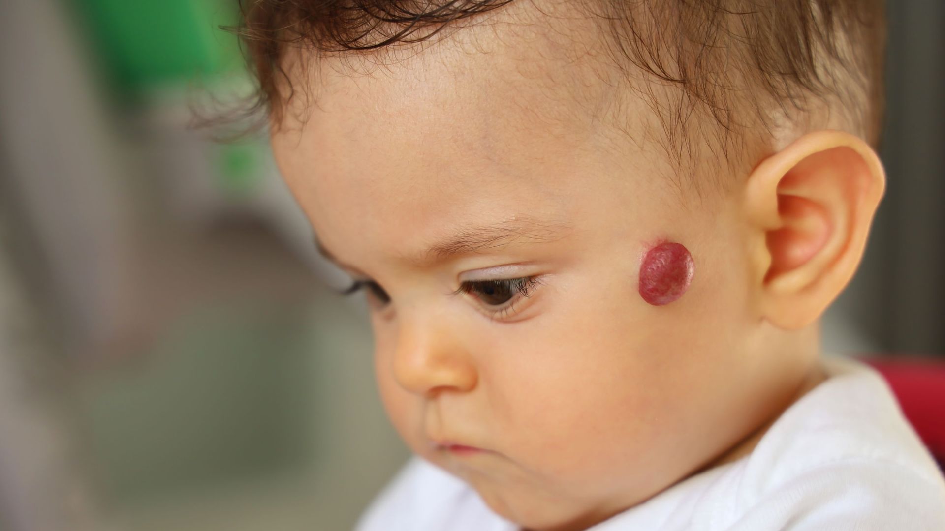 L’angiome : faut-il s’inquiéter de cette tache colorée sur la peau de ...