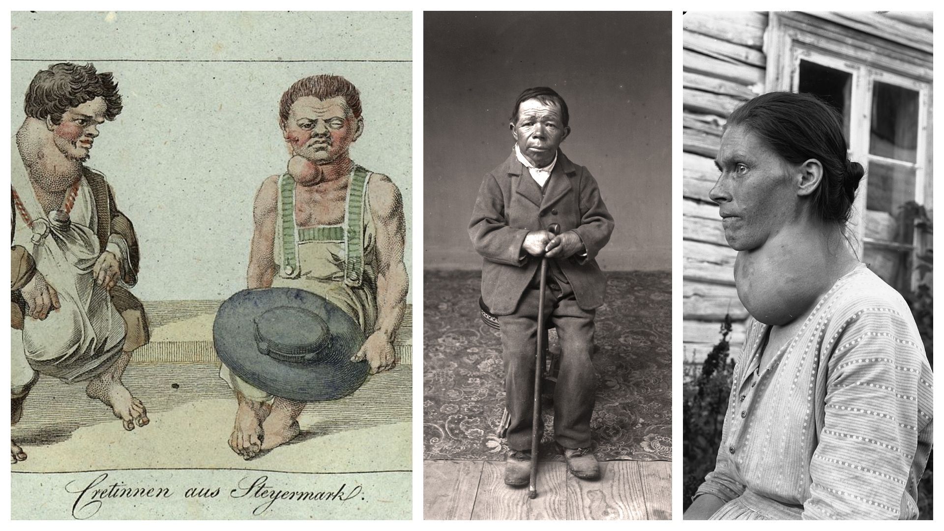 L’iode, des 'crétins des Alpes' à la pastille contre les radiations ...