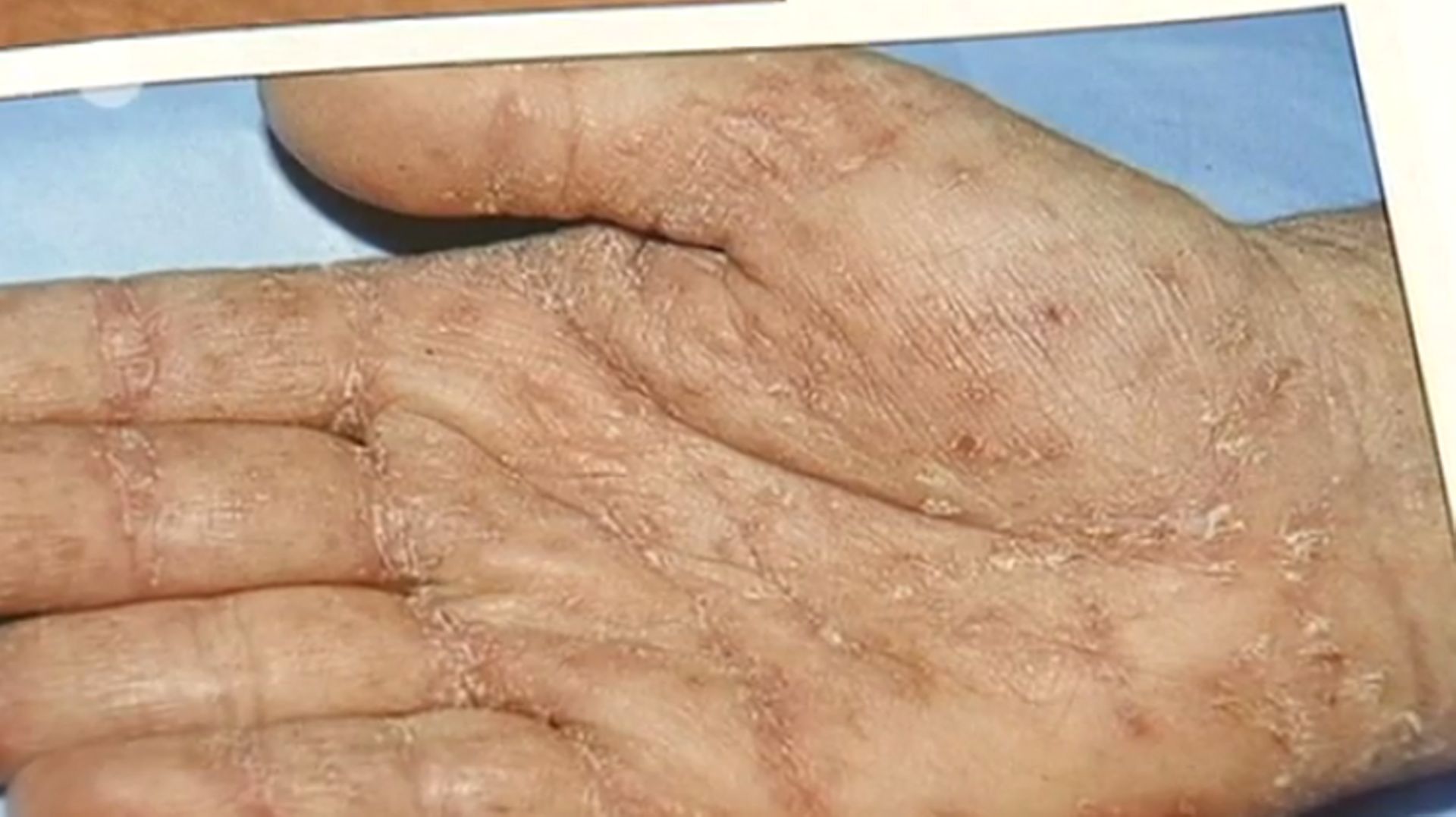 Une centaine de cas de gale suspects dans une école à Marloie ...