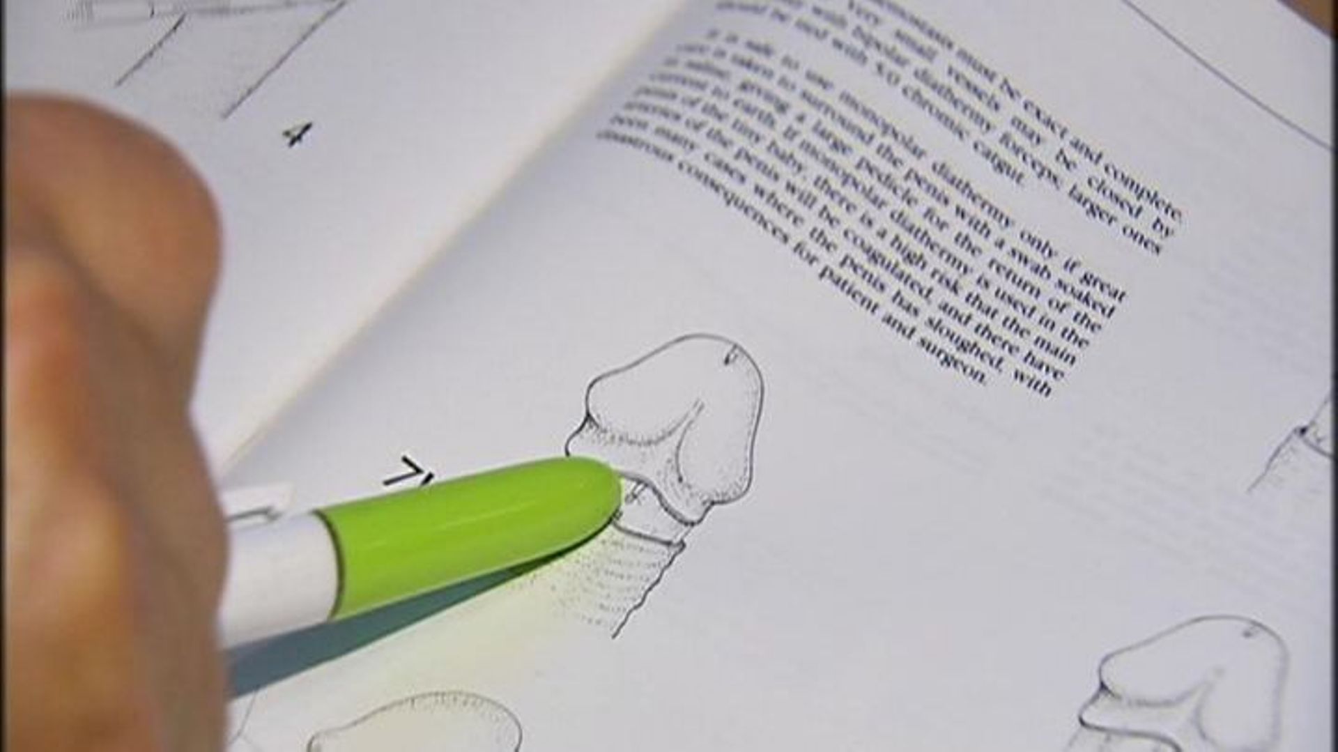 La circoncision non-médicale ne sera peut-être plus remboursée - RTBF Actus