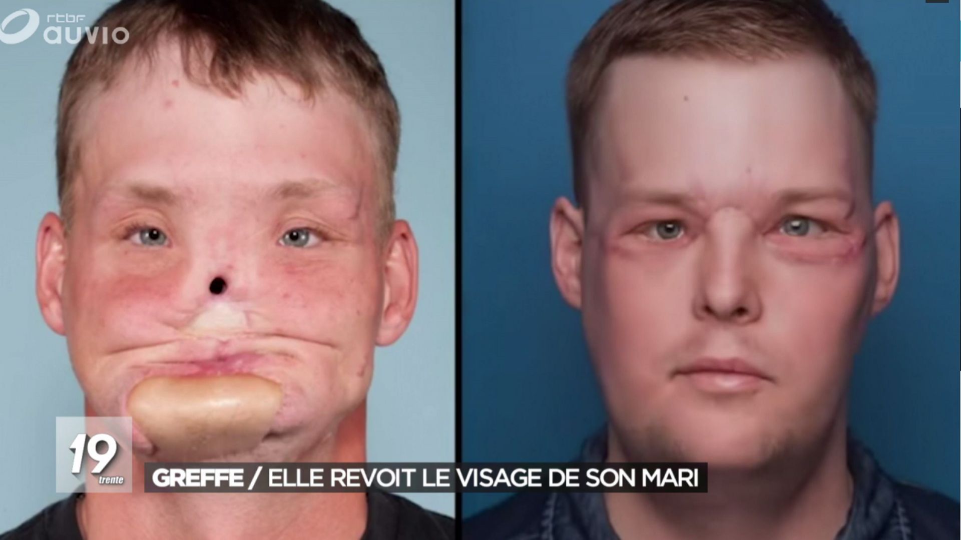 Un Américain apprend à revivre grâce à une greffe de visage - RTBF Actus