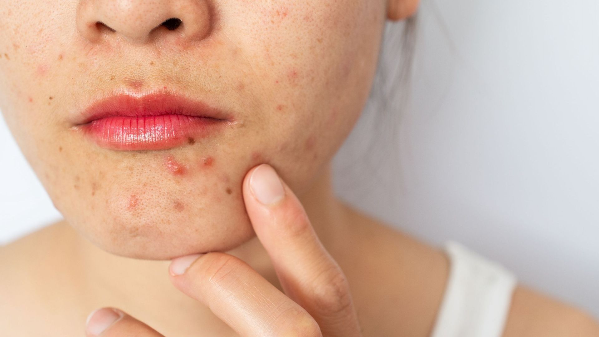 L’acné d’adulte : cette maladie inflammatoire touche une femme sur cinq ...