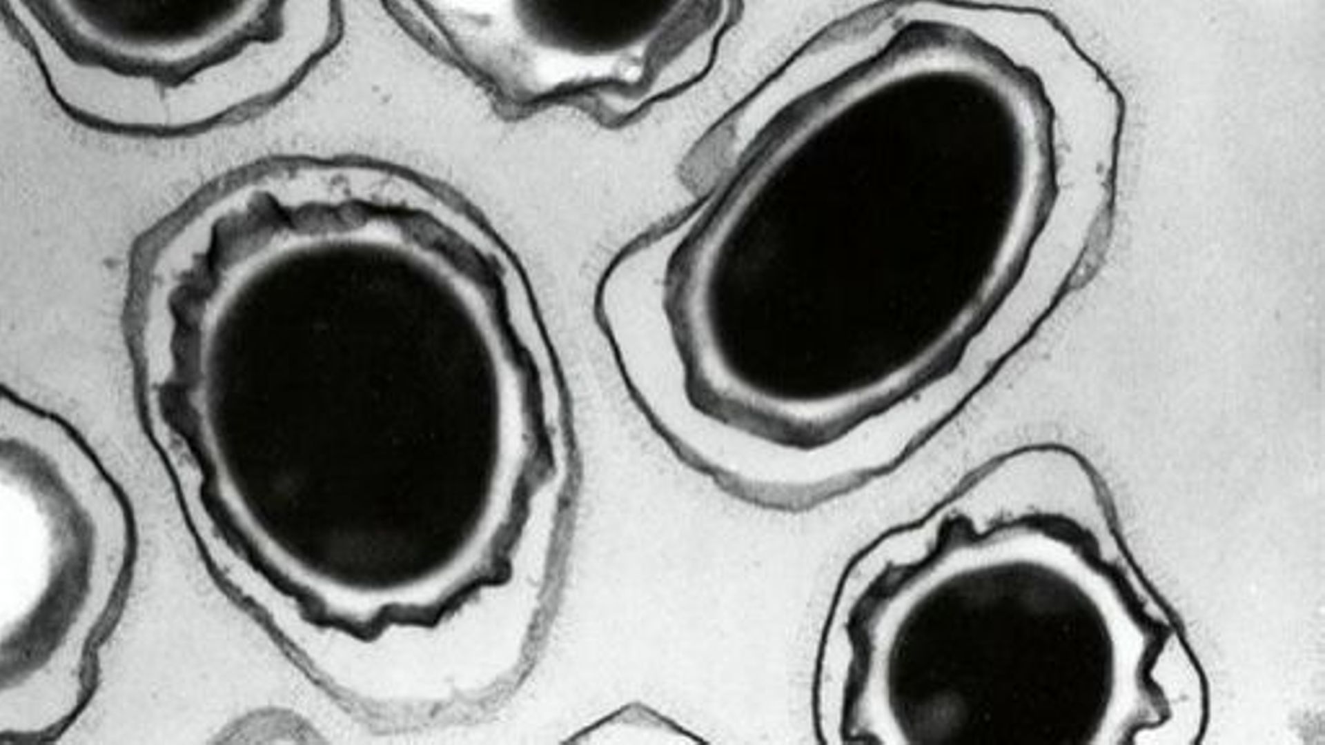 GB: alerte sanitaire sur une solution utilisée pour le don d'organes ...