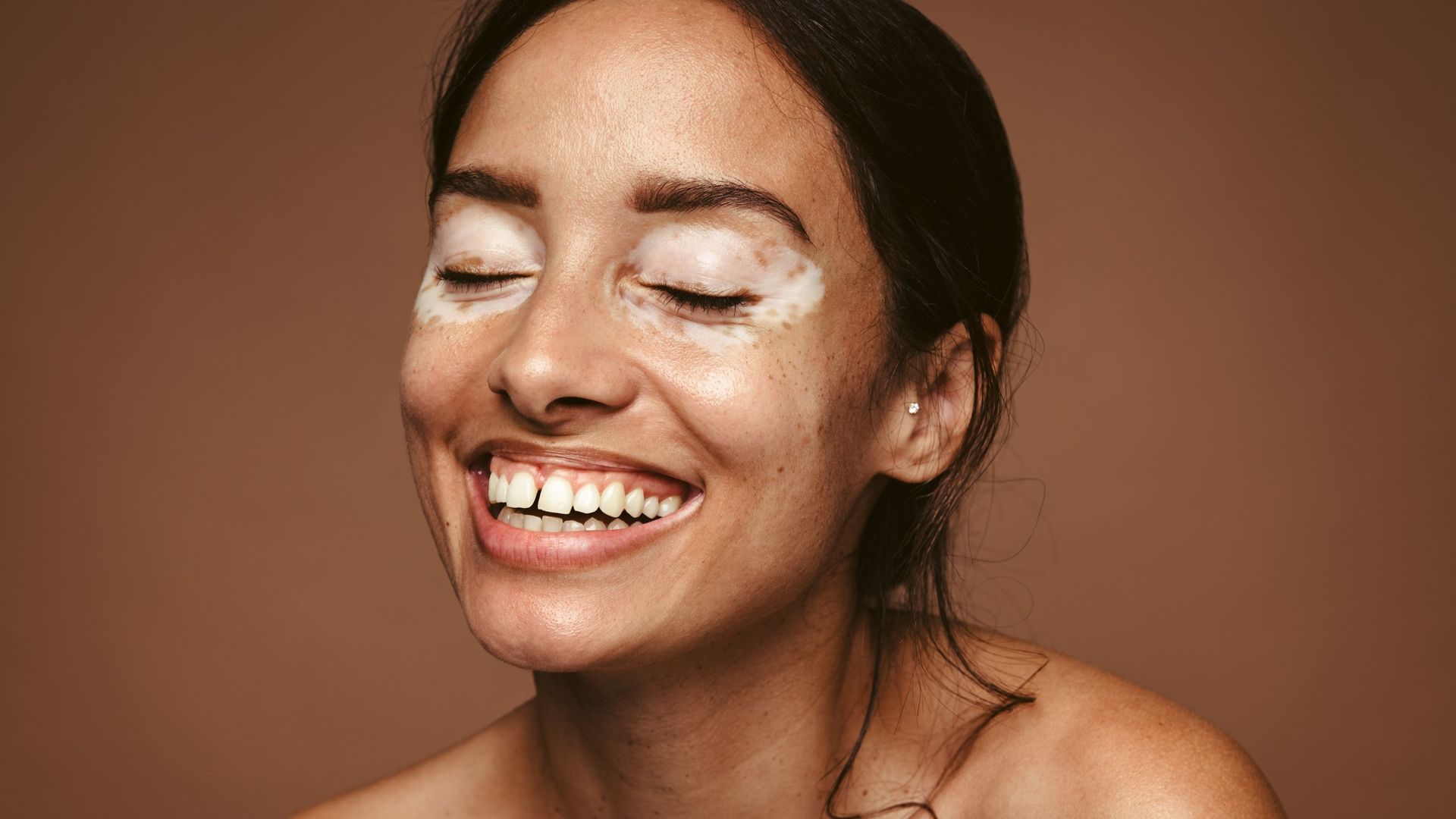 Cet hiver, attention à la dermite des chaufferettes ! - RTBF Actus