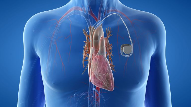 Le pacemaker : quel rôle joue-t-il pour le corps humain et comment s'en ...